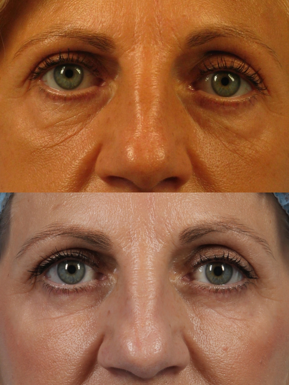 What Are Festoons? | Dr. Brett Kotlus, Cosmetic Oculoplastic Surgeon, NYC