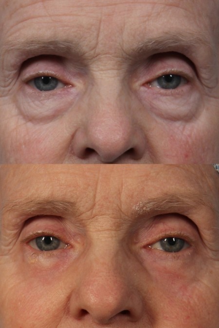 Lower Eyelid Lift (female) - Dr. Brett Kotlus