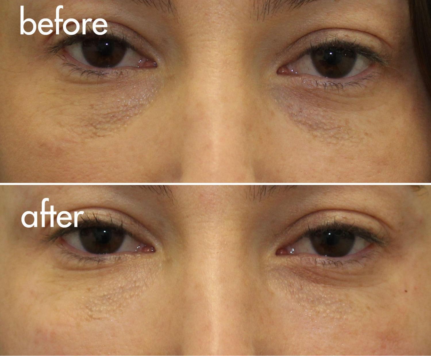 Cannula Tear Trough Filler | Dr. Brett Kotlus, Cosmetic Oculoplastic ...