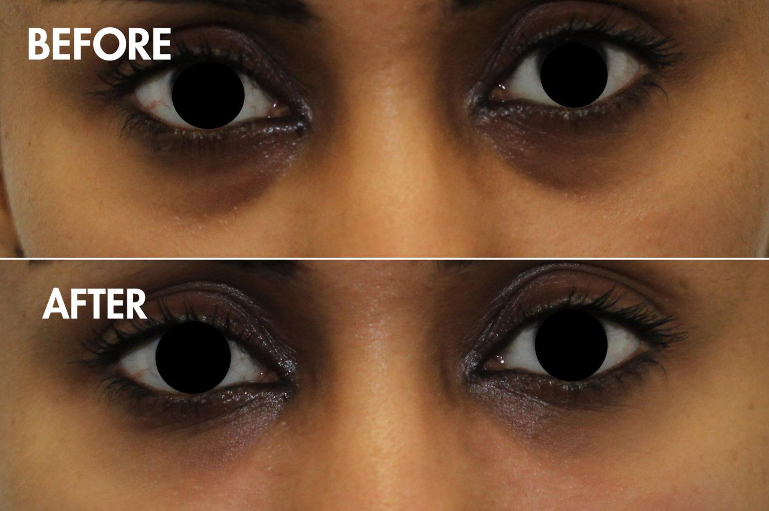 Cannula Tear Trough Filler | Dr. Brett Kotlus, Cosmetic Oculoplastic ...