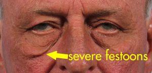 What Are Festoons? | Dr. Brett Kotlus, Cosmetic Oculoplastic Surgeon, NYC