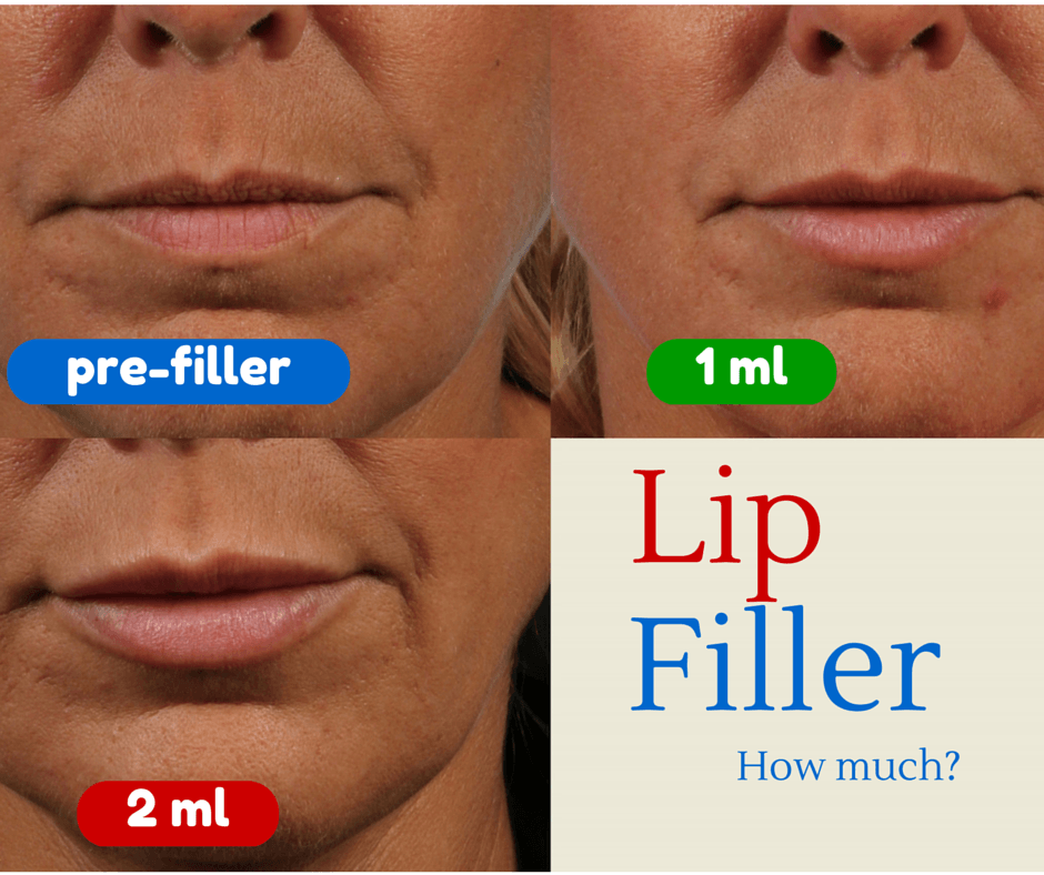How Much Lip Filler Do I Need Dr Brett Kotlus Cosmetic How Much Lip Filler Do I Need Dr Brett Kotlus Cosmetic