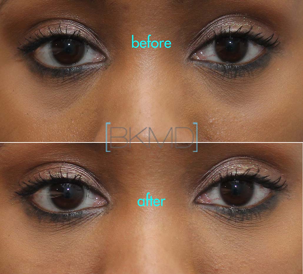 Under Eye Filler - Dr. Brett Kotlus