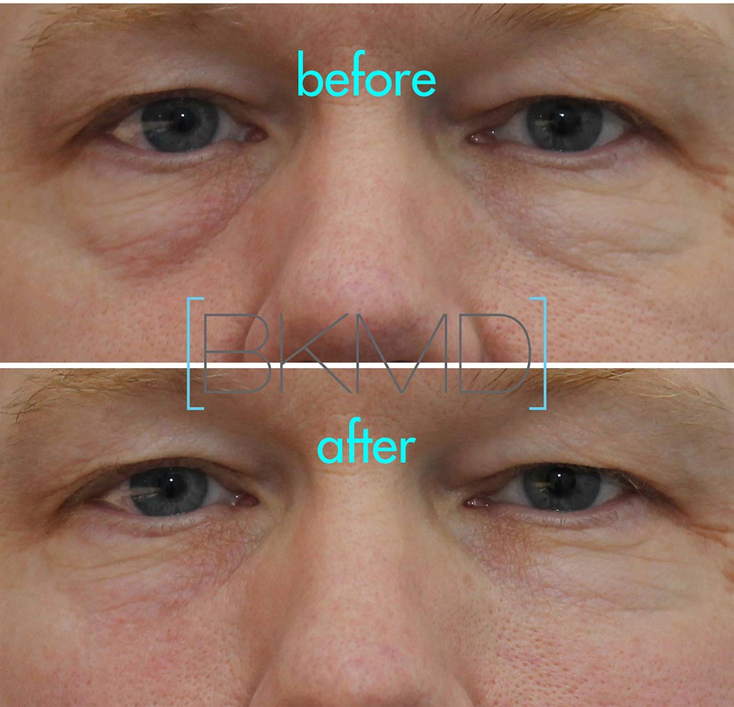 Under Eye Filler - Dr. Brett Kotlus