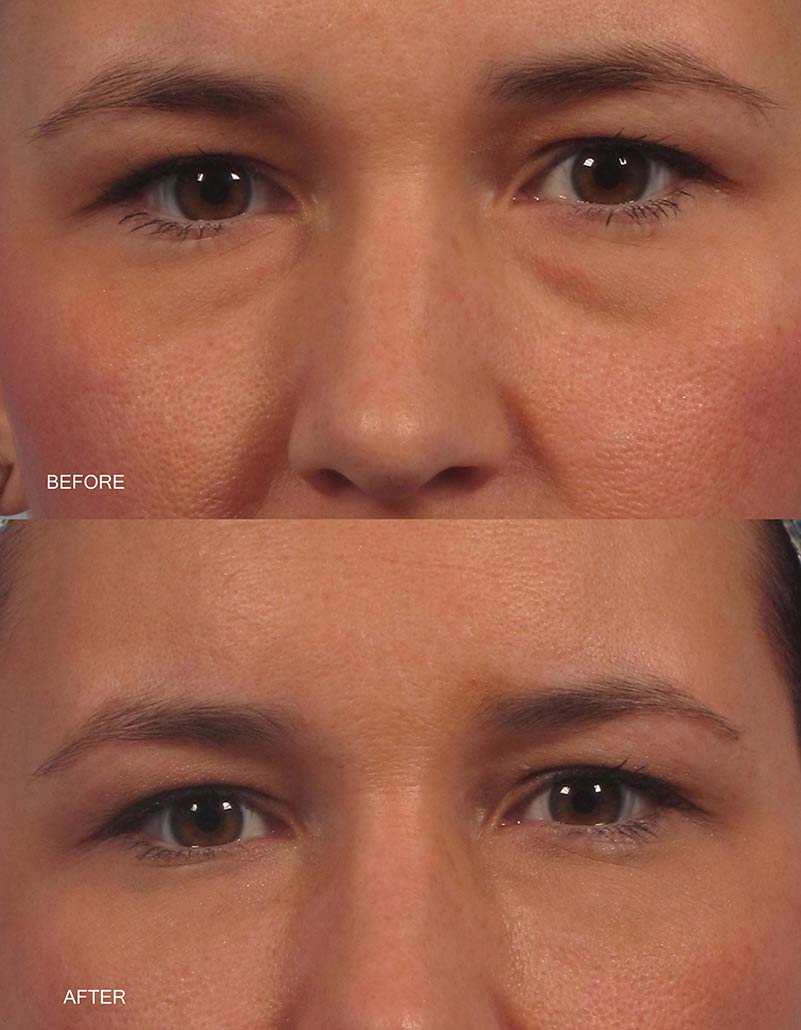 Under Eye Filler - Dr. Brett Kotlus