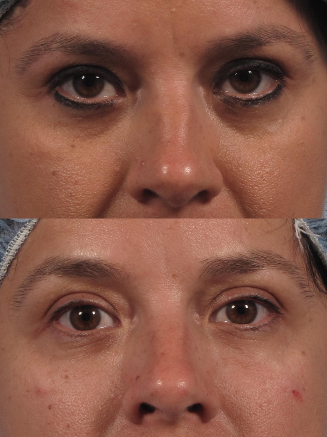 Under Eye Filler - Dr. Brett Kotlus
