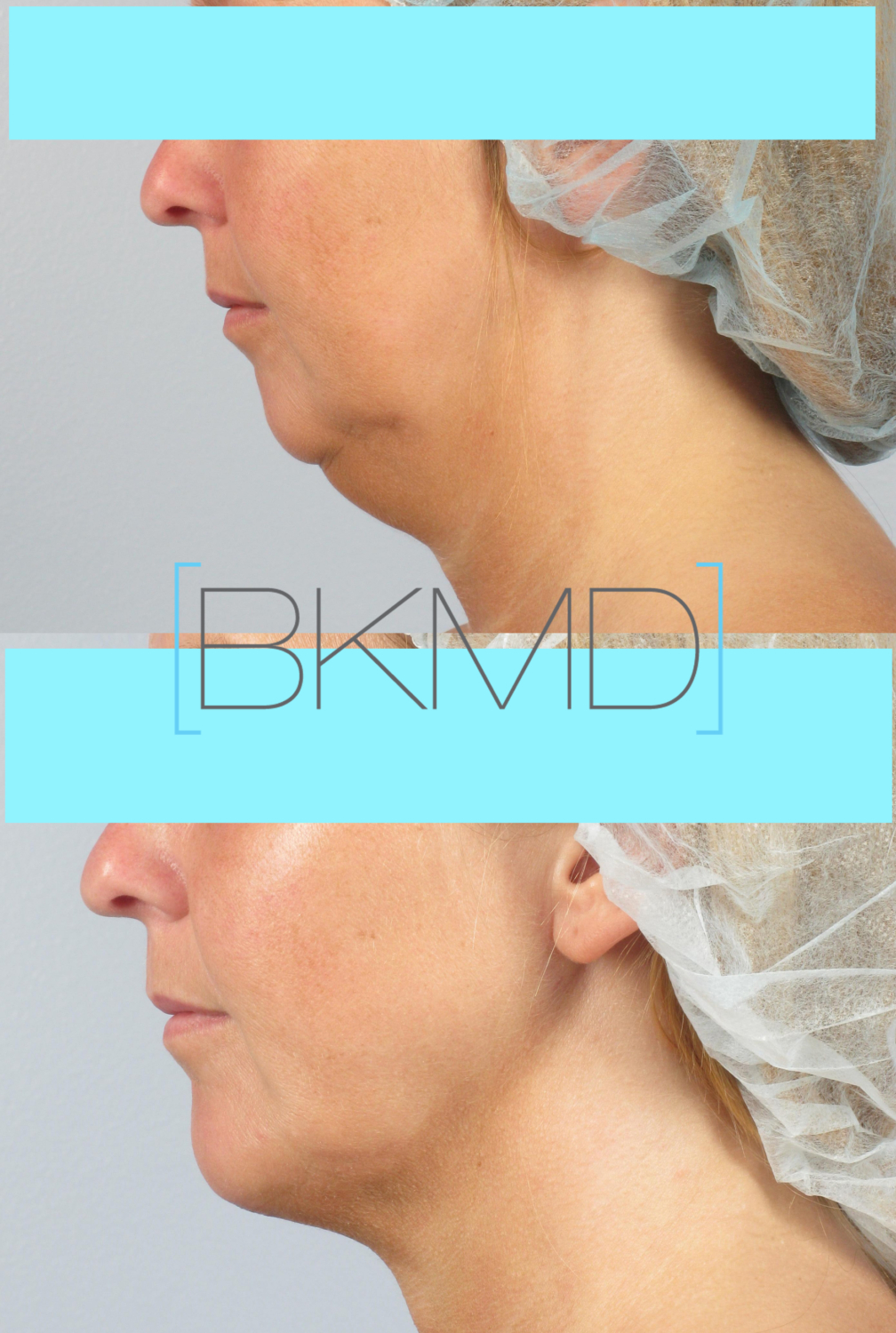 Neck Liposculpting - Dr. Brett Kotlus